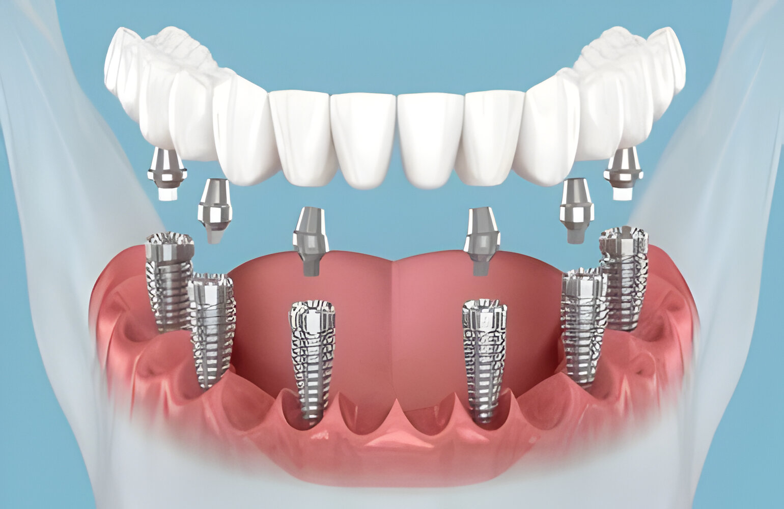 Dental Implants: A Permanent Solution for Missing Teeth - Replace Roots Dental Implants: A Permanent Solution for Missing Teeth - Replace Roots